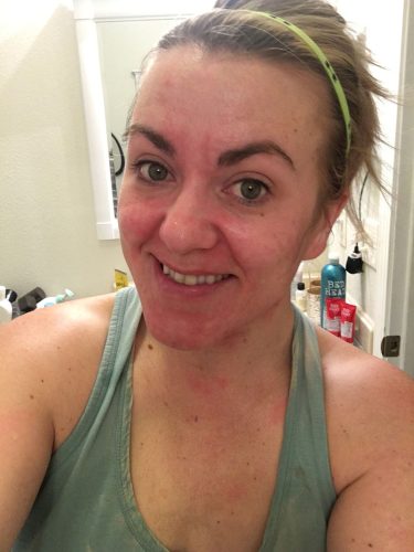 Before and After - DERMAKI