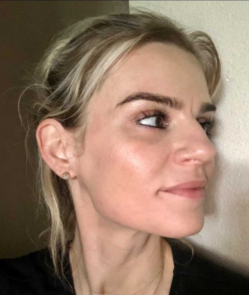 Before and After - DERMAKI