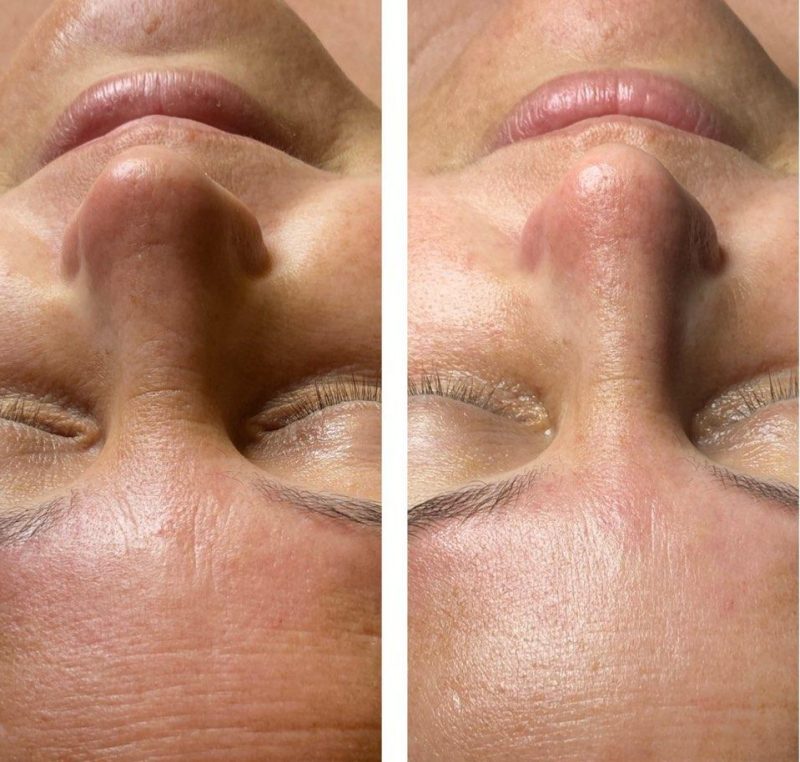 Before and After - DERMAKI