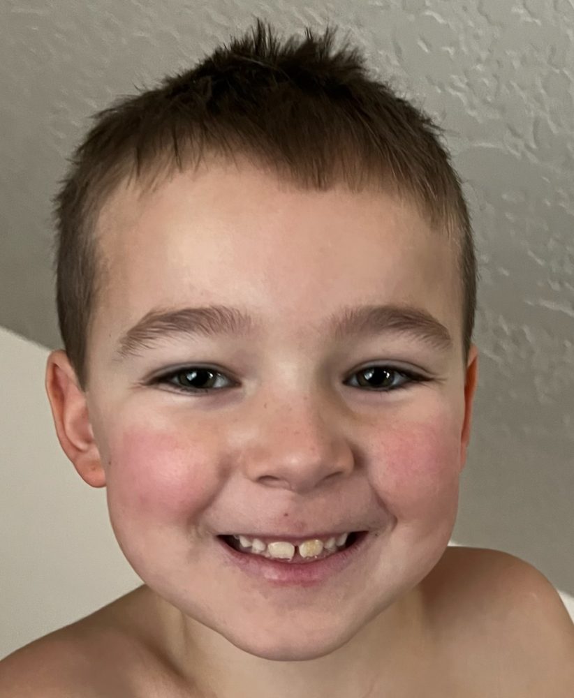 Before and After - DERMAKI