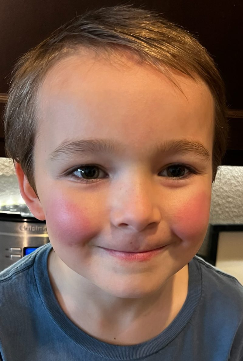 Before and After - DERMAKI