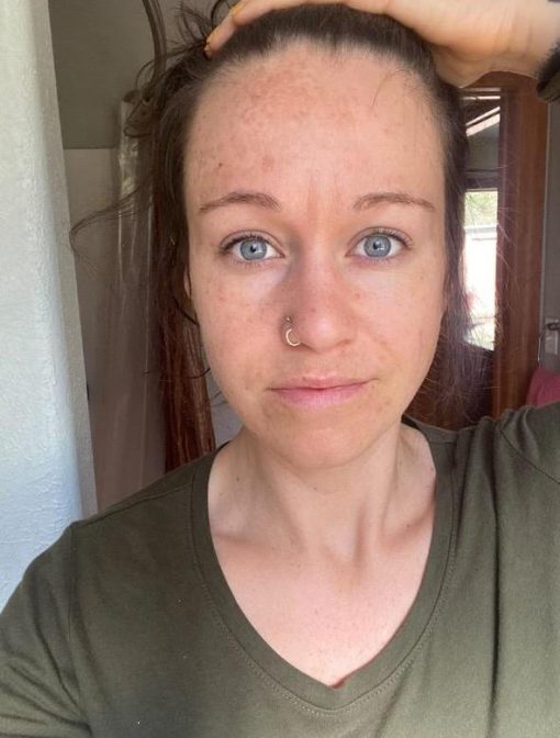 Before and After - DERMAKI