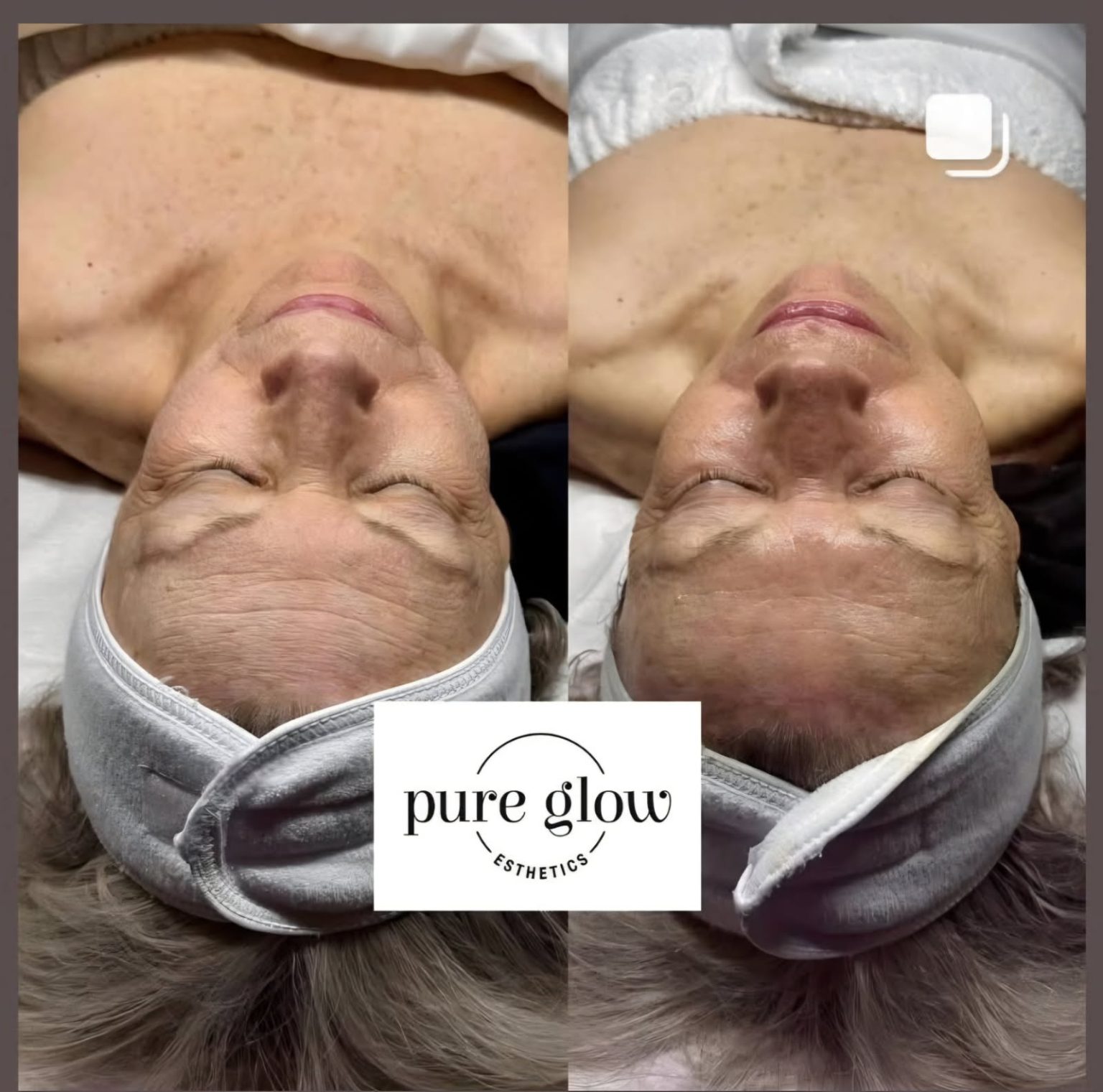 Before and After - DERMAKI